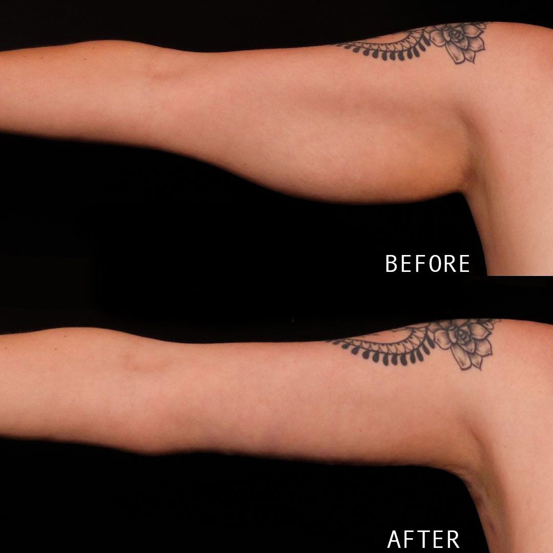 Arm Lift – Center of Surgeons